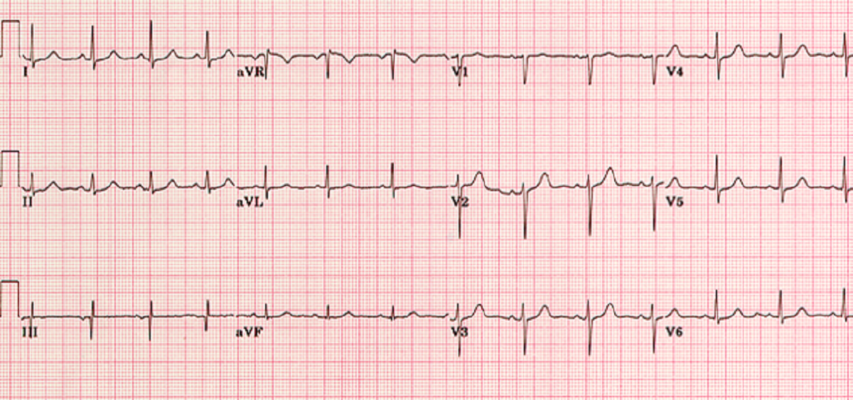 EKG 01 | Take the Quiz | QuizMaker