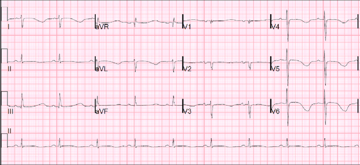 EKG 14 | Take the Quiz | QuizMaker